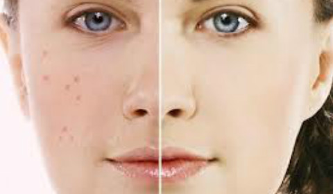 Preguntas frecuentes :: Cer0 Acne